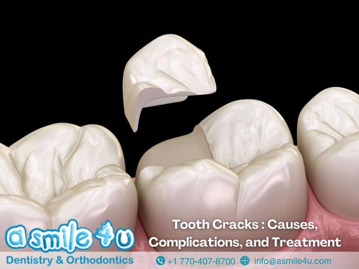 Tooth Cracks: Causes, Complications & Treatments