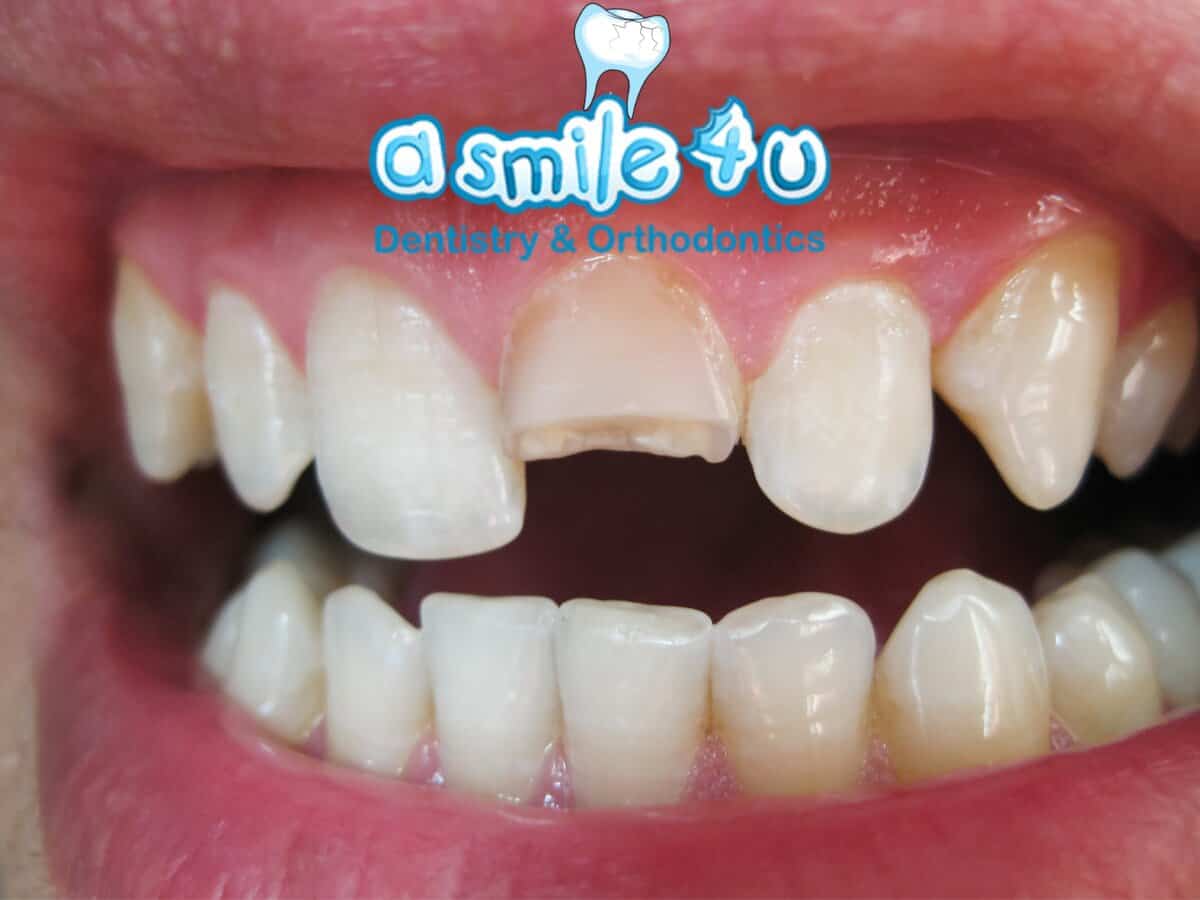 Tooth Cracks: Causes, Complications & Treatments