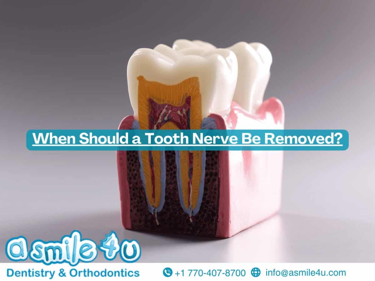 When Should a Tooth Nerve Be Removed? - A Smile 4 U