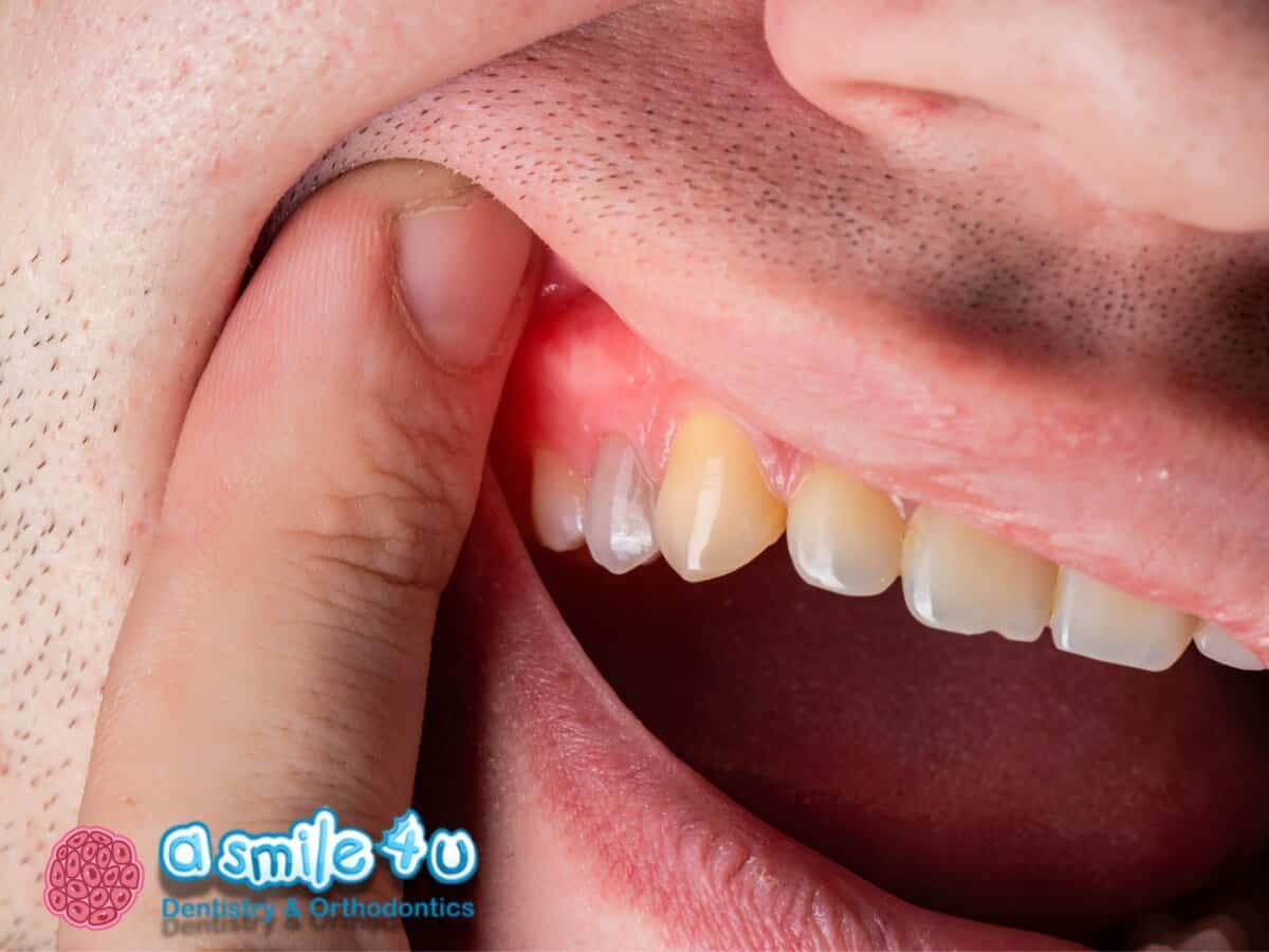 Jaw Tumors and Cysts: Causes and Treatments - A Smile 4 U