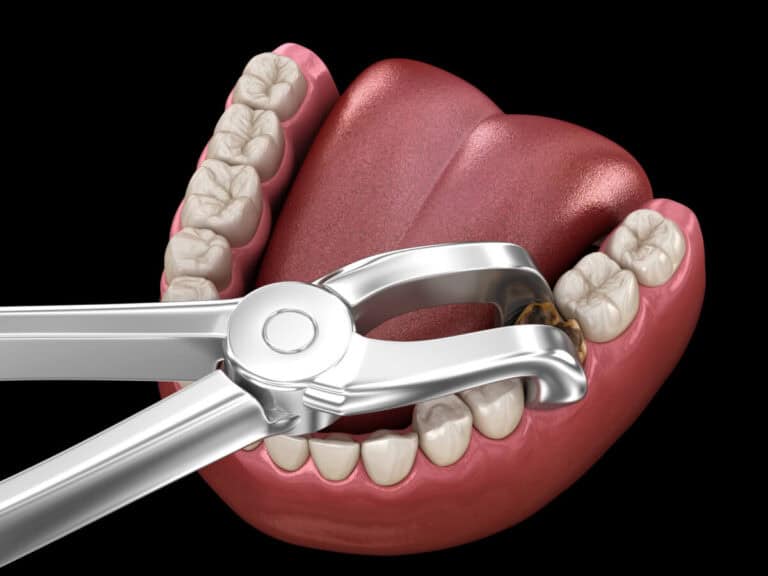 What to Expect Before, During & After a Tooth Extraction