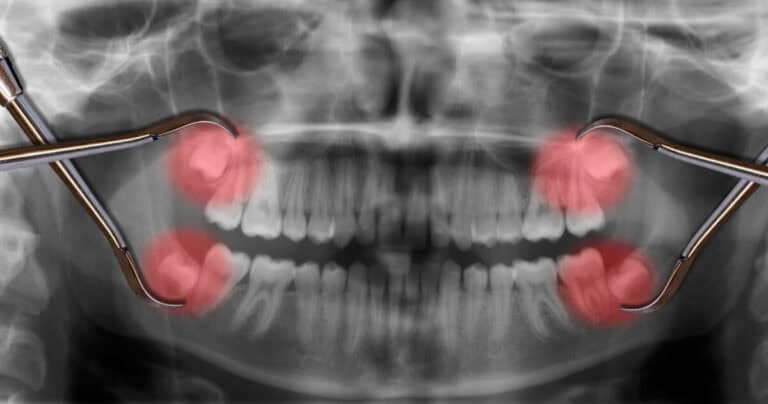What to Expect Before, During & After a Tooth Extraction